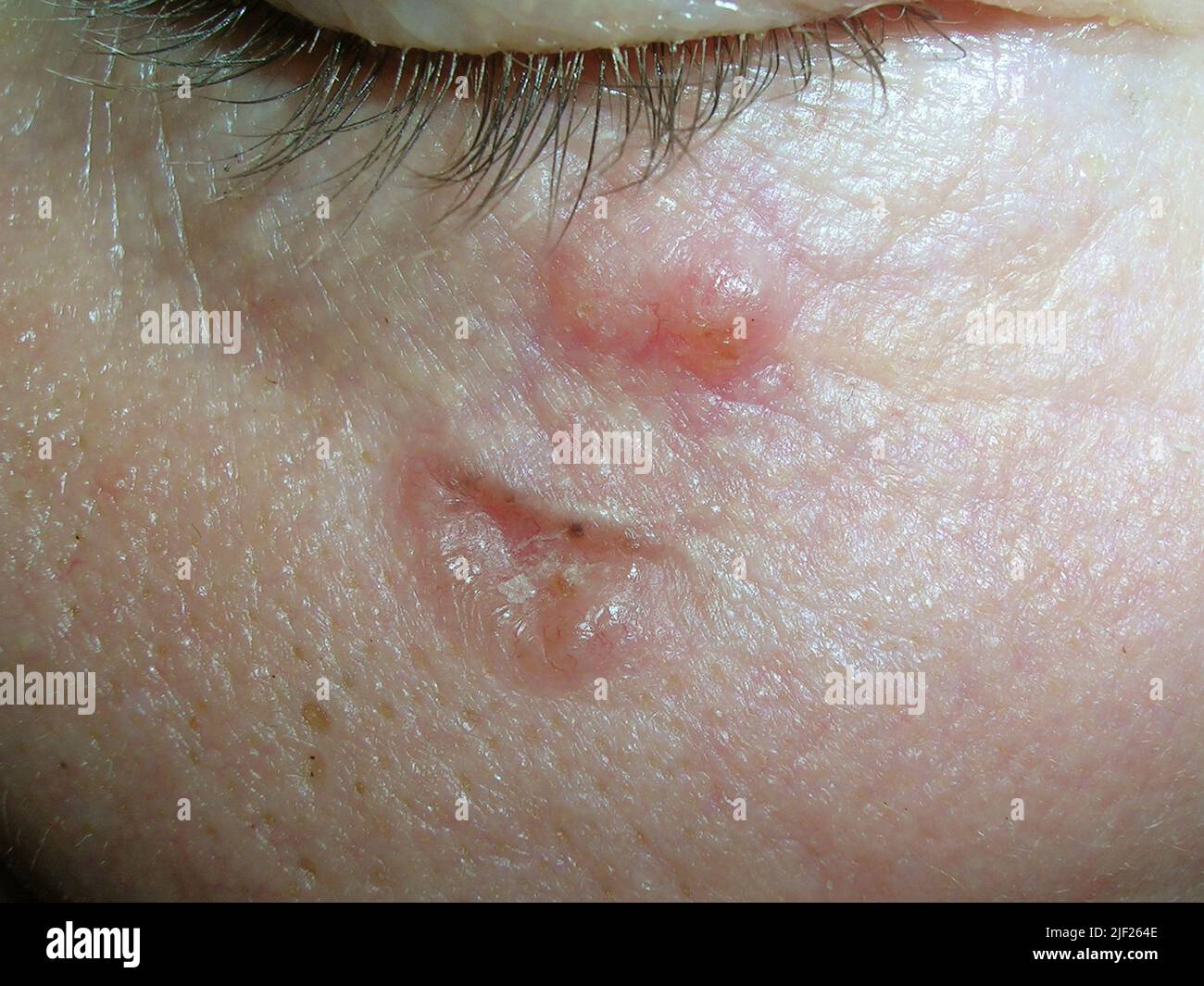 Basal Cell Carcinomas Bcc Or Rodent Ulcers On The Face Of A White