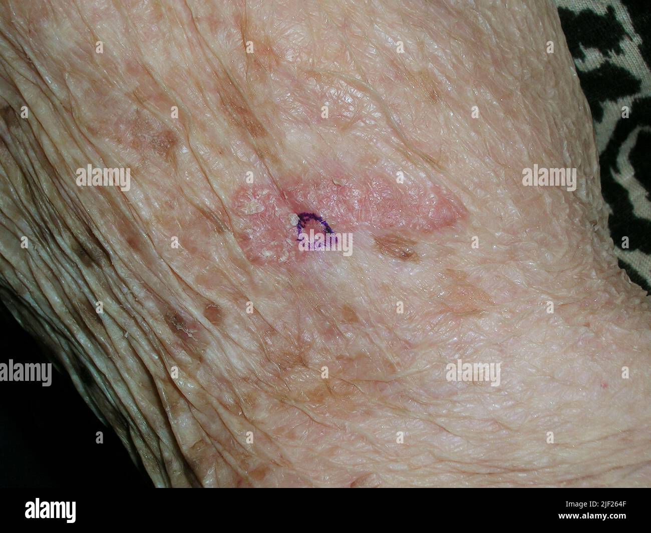Squamous cell carcinoma (SCC) on the right arm of a 97 year old ...