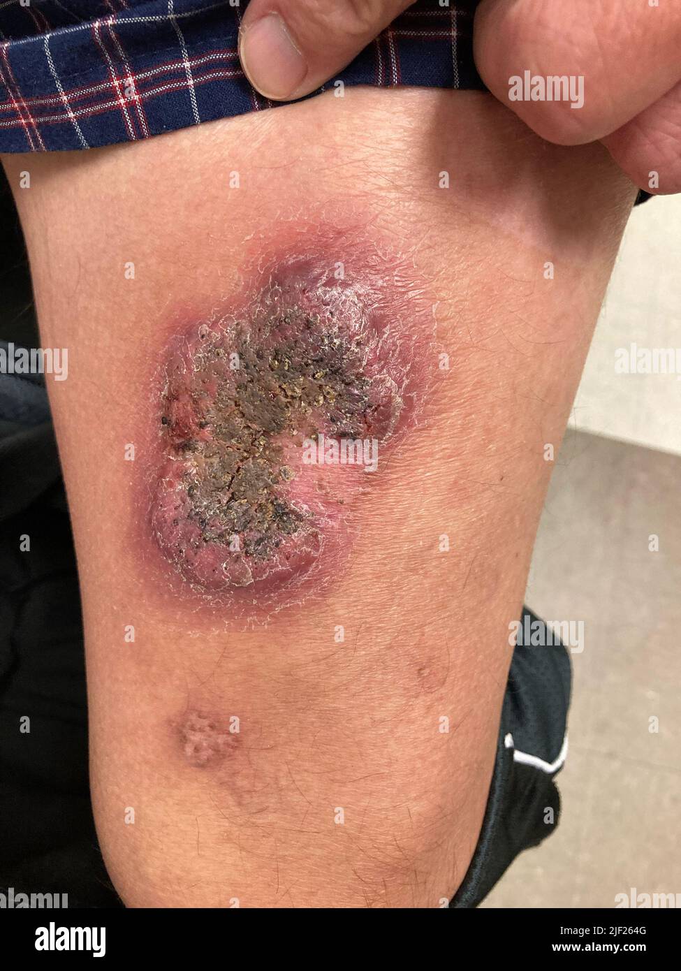 Pyoderma Gangrenosum