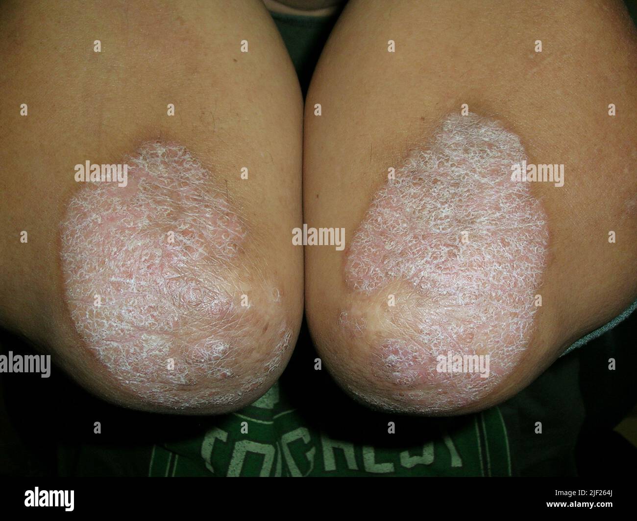 Psoriasis on the elbows of a 40 year old Hispanic male. Psoriasis is a ...