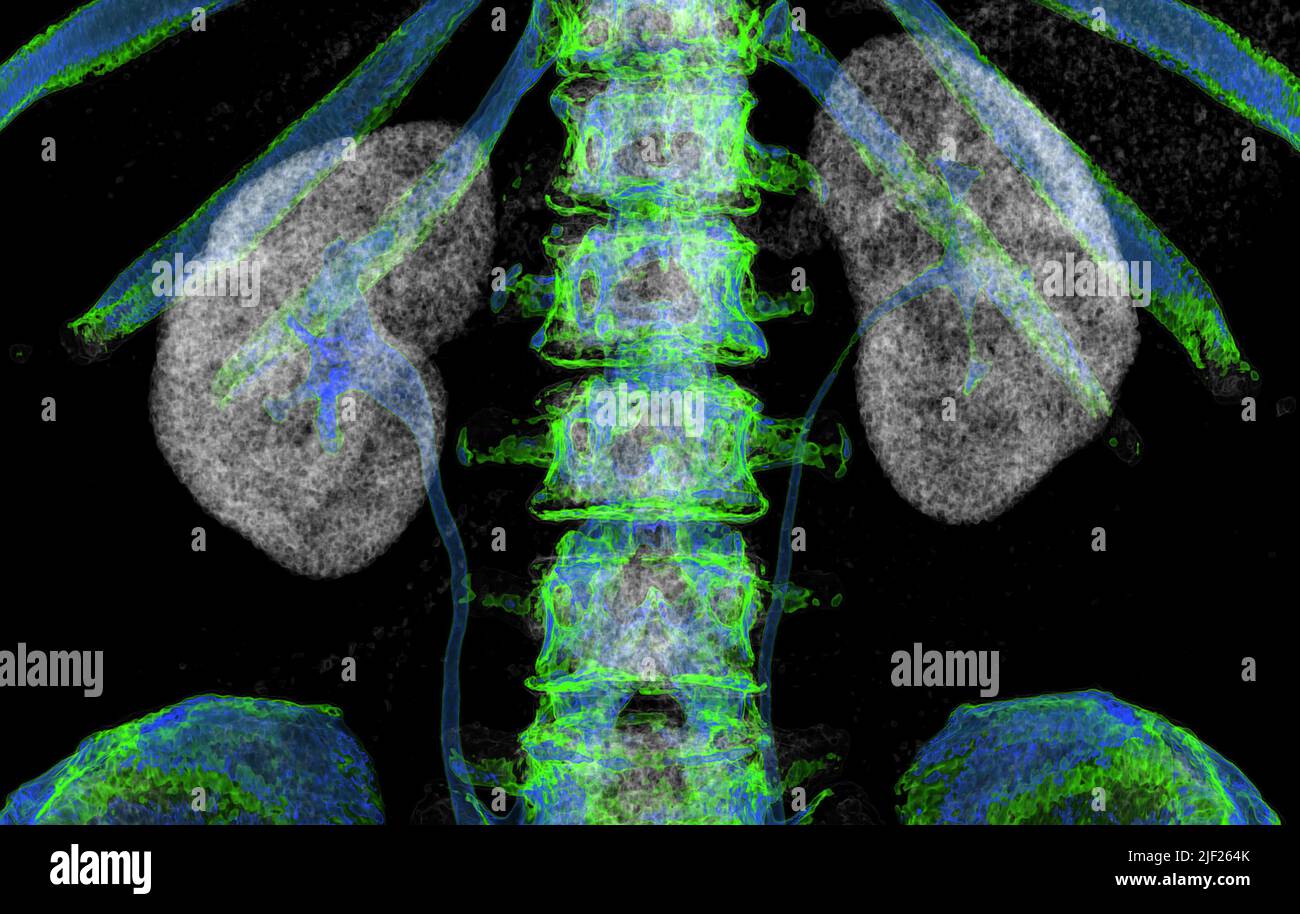 Coloured computed tomography (CT) scan of healthy human kidneys (grey ...