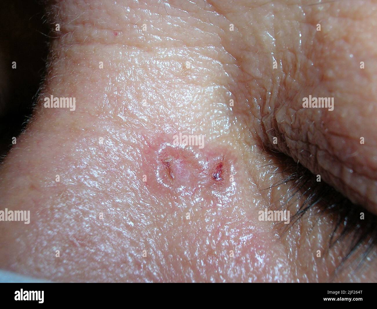 Nodular basal cell carcinoma (BCC), or rodent ulcer. This is the most ...