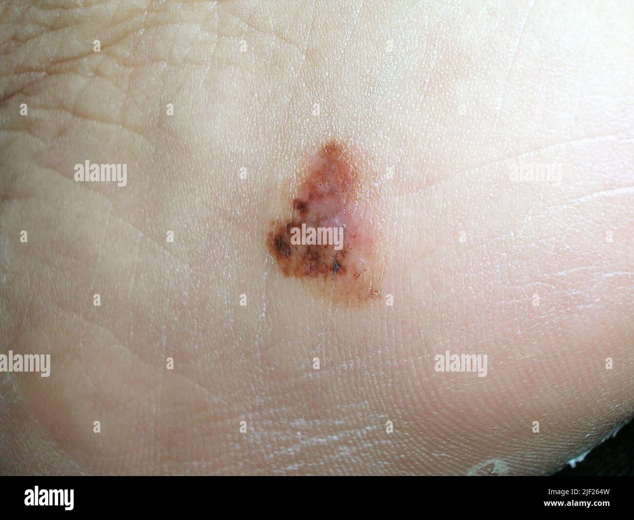 Melanoma on the foot, measuring 0.9mm. Melanoma is a form of skin ...