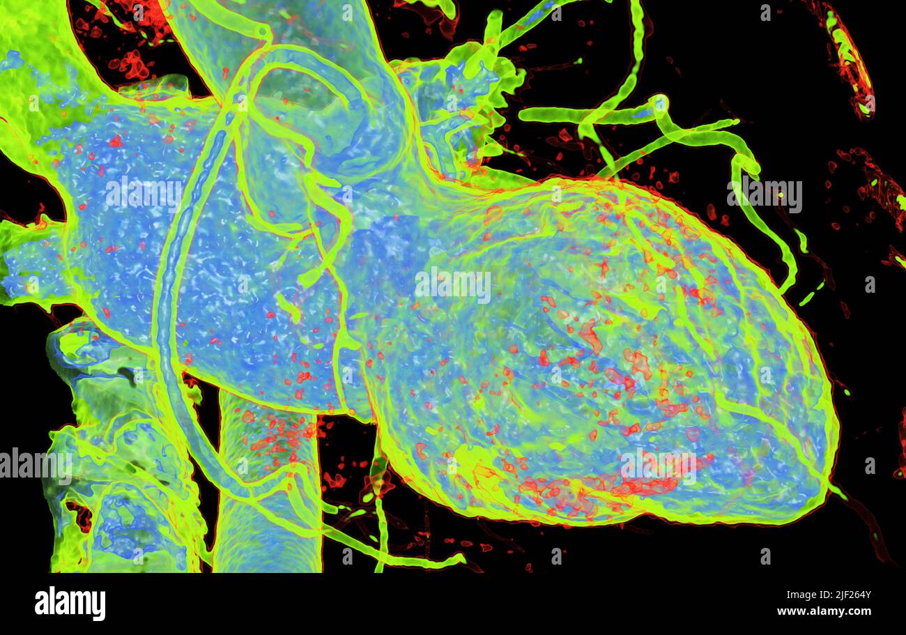Coloured 3D computed tomography (CT) angiogram scan showing atheromatous plaques in the coronary ...