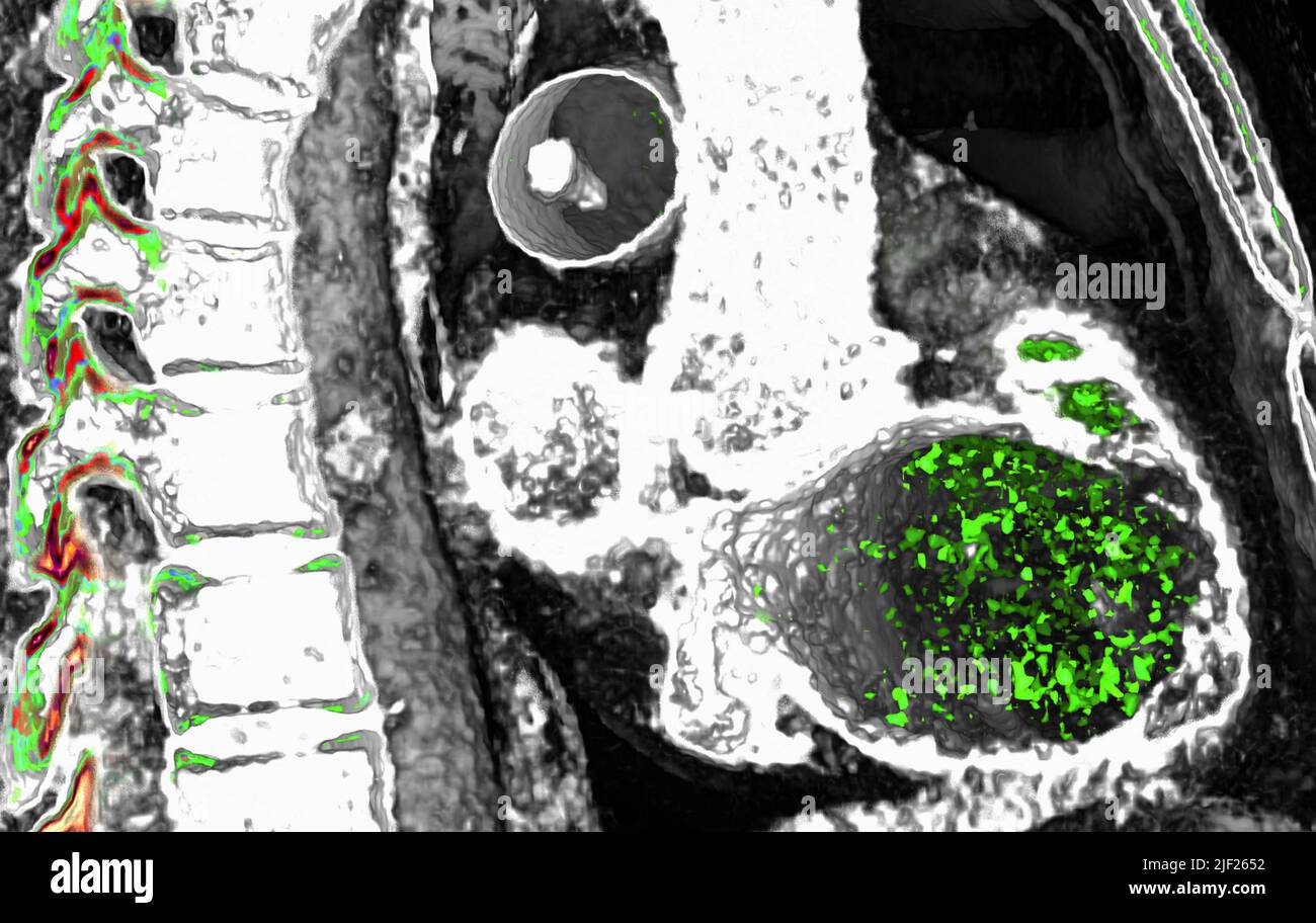 Coloured 3D computed tomography (CT) scan of an embolism (blood clot ...