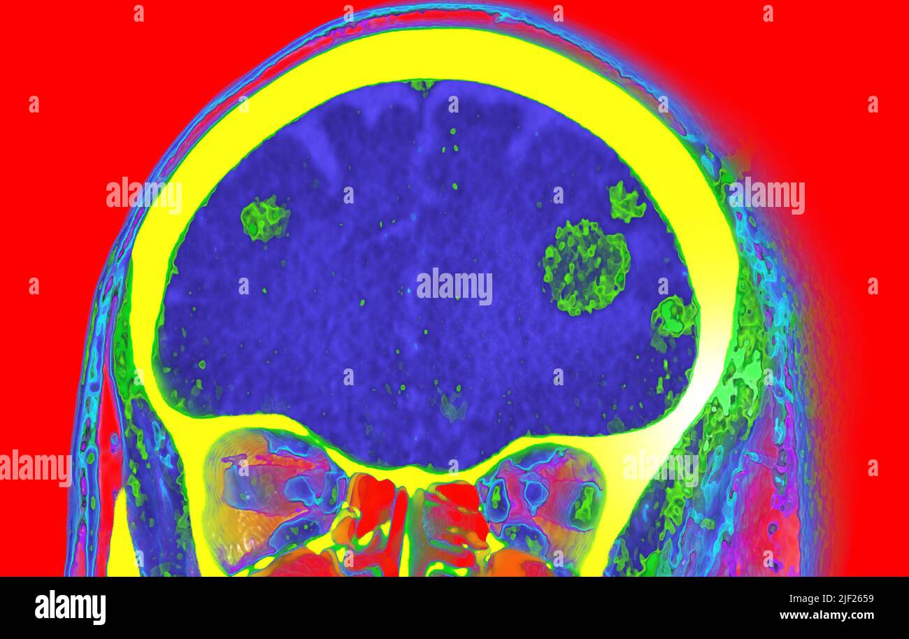 Coloured computed tomography (CT) scan showing secondary malignant (cancerous) tumours (green ...