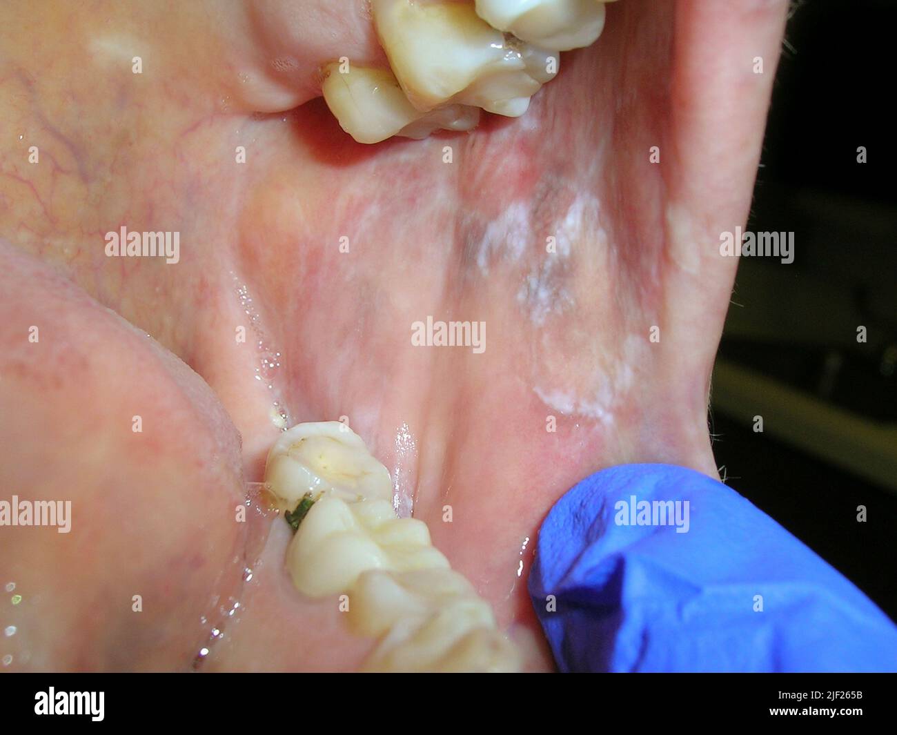 Oral Lichen Planus Lichen Planus Is An Inflammatory Disorder Of The Skin And Mucous Membranes