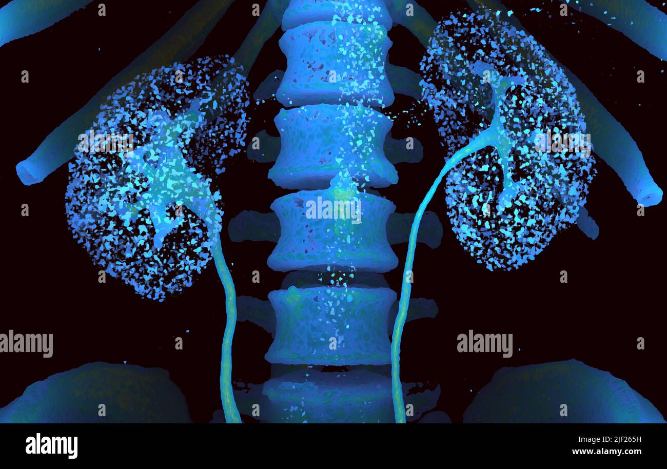 Coloured computed tomography (CT) scan of healthy human kidneys (right ...