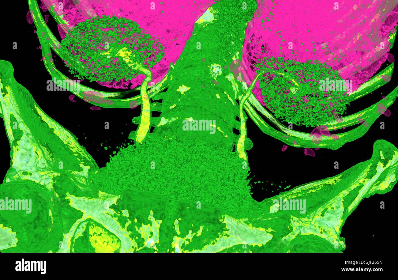 Coloured computed tomography (CT) scan of healthy human kidneys (green ...