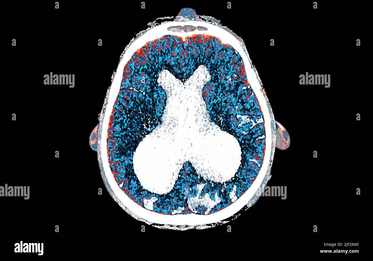 Coloured computed tomography (CT) scan of the brain of a patient with hydrocephalus (fluid on ...