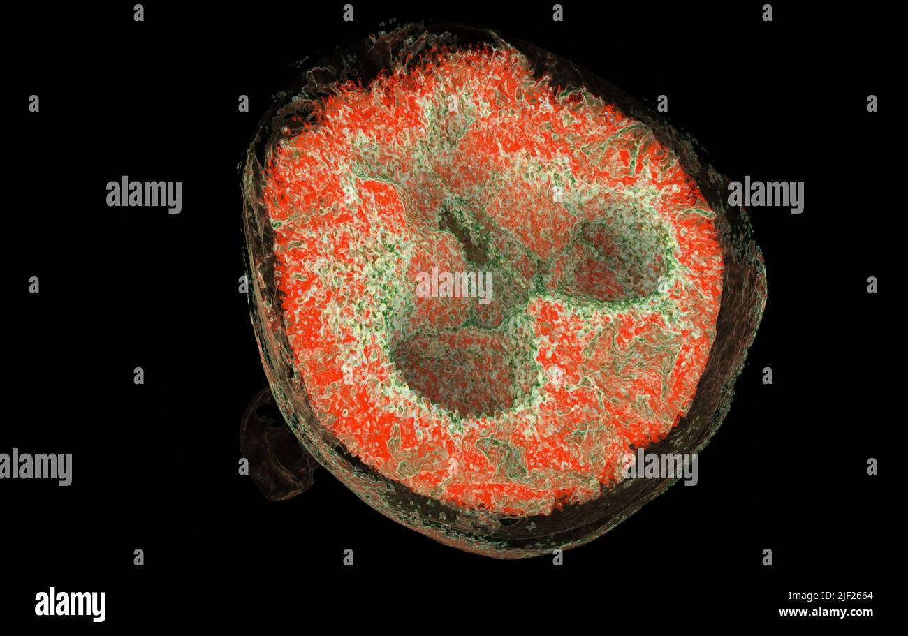 Coloured computed tomography (CT) scan of the brain of a patient with ...