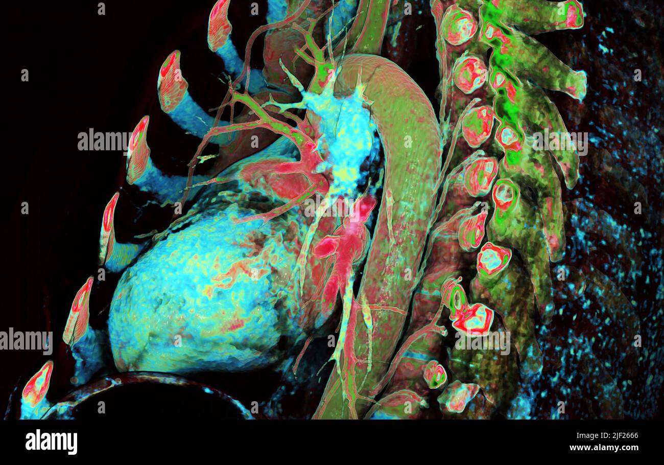 Coloured 3D computed tomography (CT) scan of a healthy mediastinum. The mediastinum is the area ...