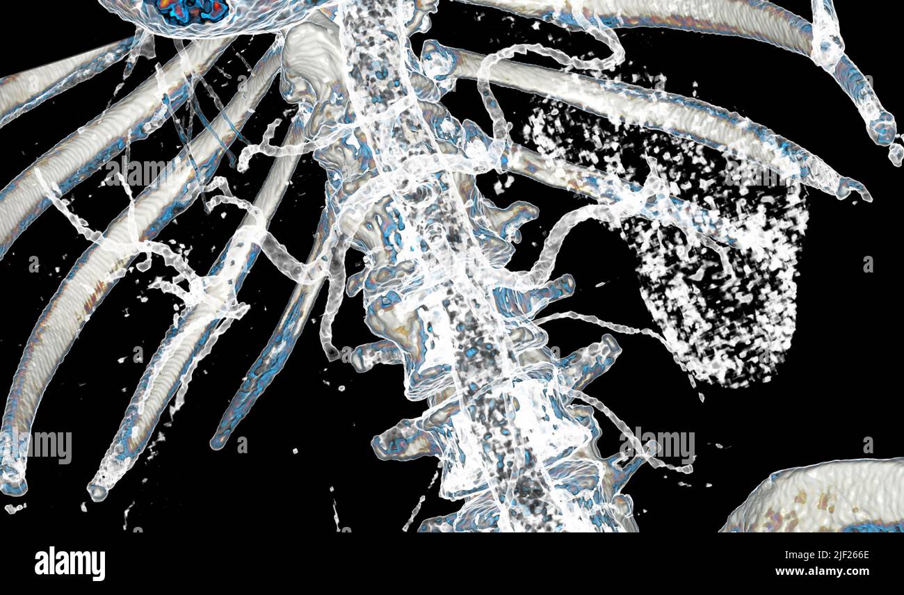Coloured 3D computed tomography (CT) scan of a covid-19 patient with a ...
