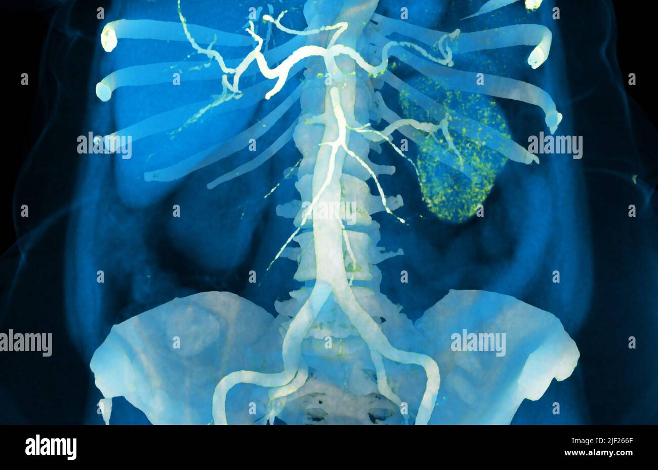 Coloured 3D computed tomography (CT) scan of a covid-19 patient with a ...