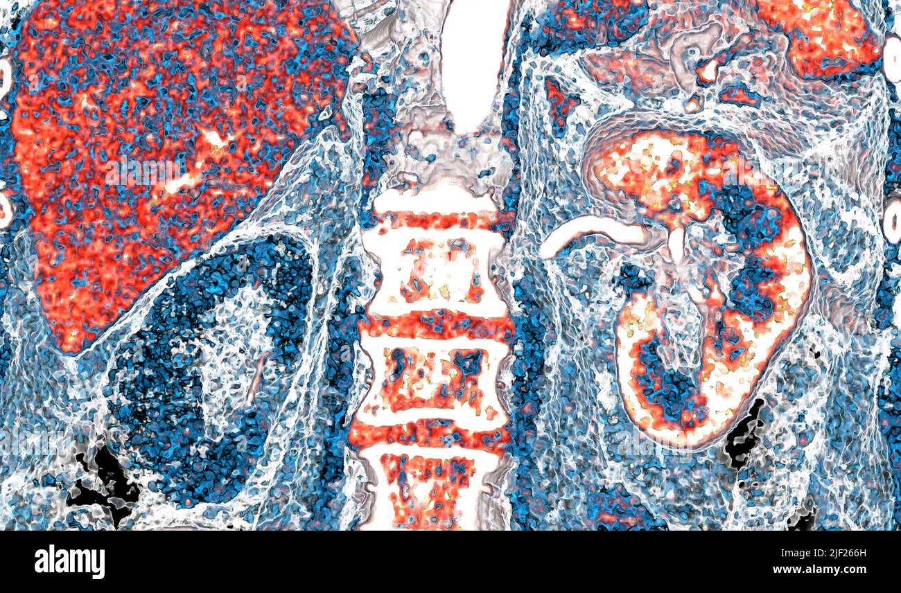 Coloured computed tomography (CT) scan of a covid-19 patient with a ...