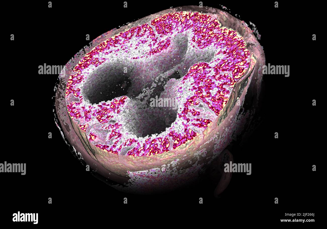 Coloured computed tomography (CT) scan of the brain of a patient with ...