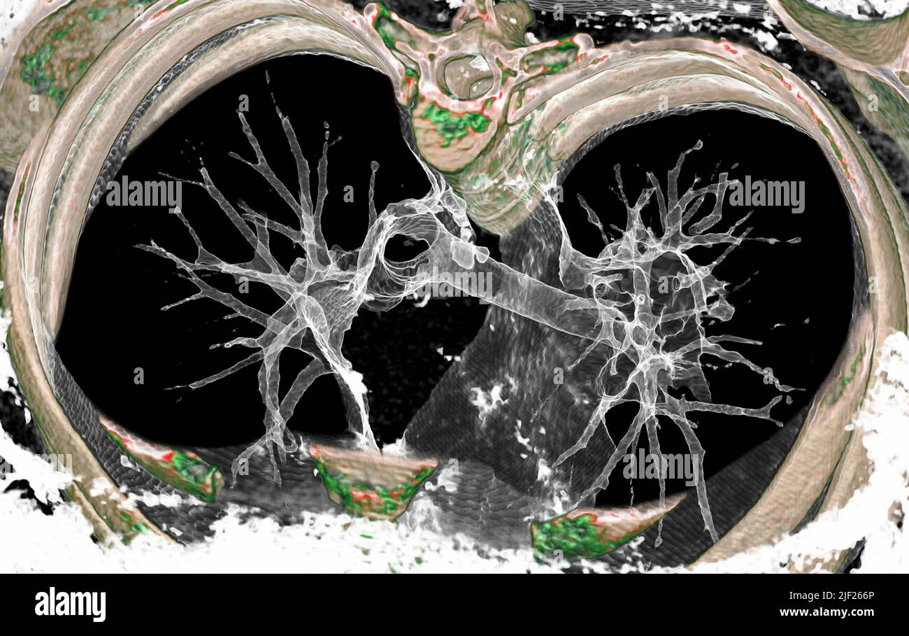 Coloured 3D computed tomography (CT) scan of healthy lungs (black) and mediastinum (centre). The ...
