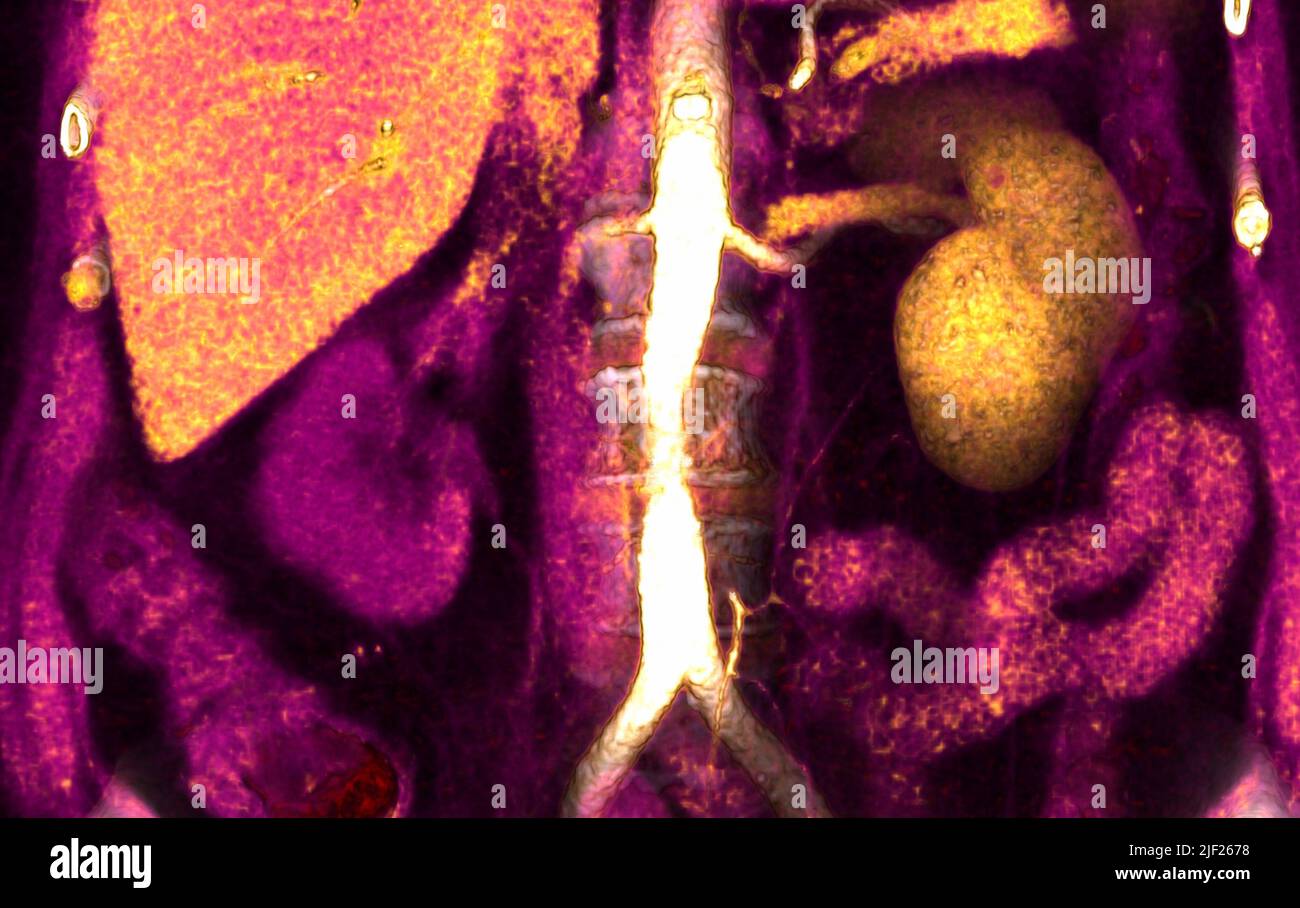 Coloured 3D computed tomography (CT) scan of a covid-19 patient with a ...