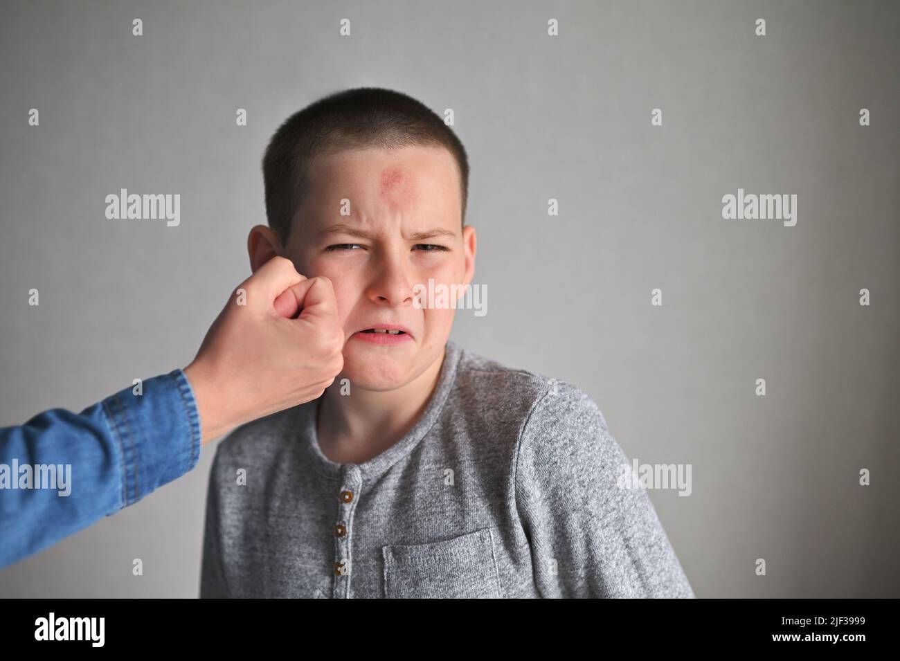 Bruise child hi-res stock photography and images - Alamy