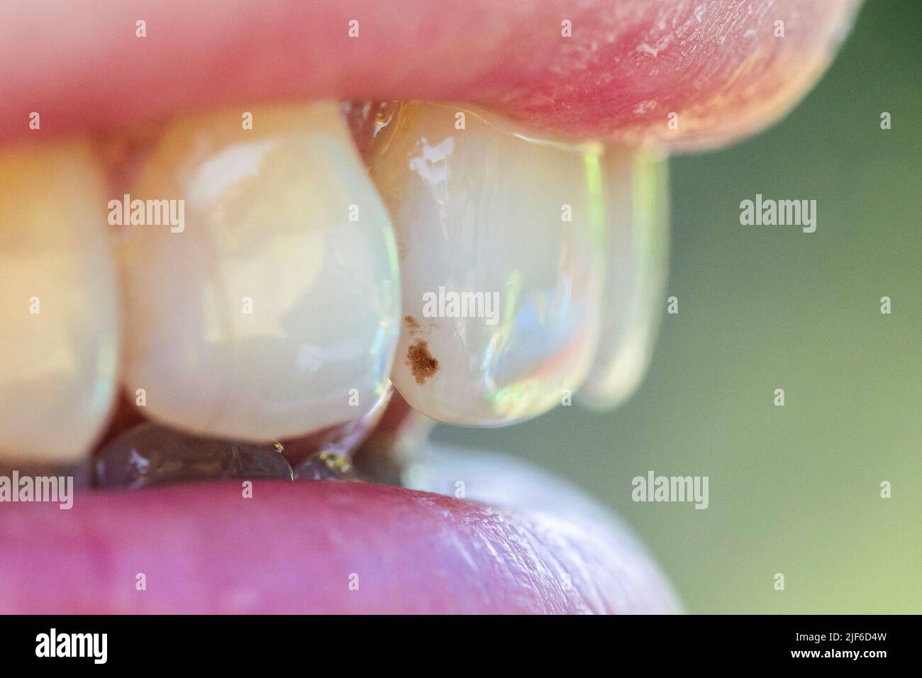 Orthodontic care plan hi-res stock photography and images - Alamy