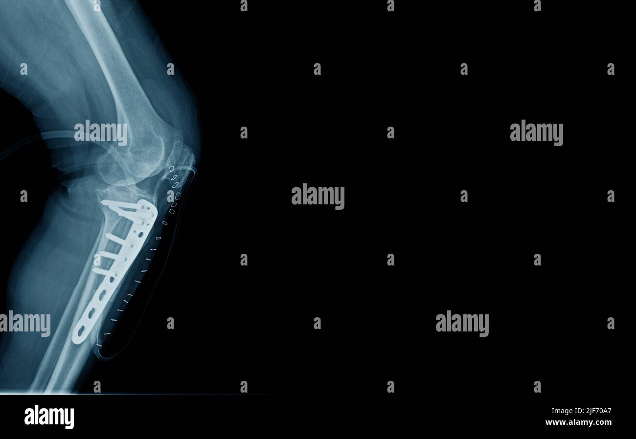 lateral view of proximal tibia fracture Stock Photo - Alamy