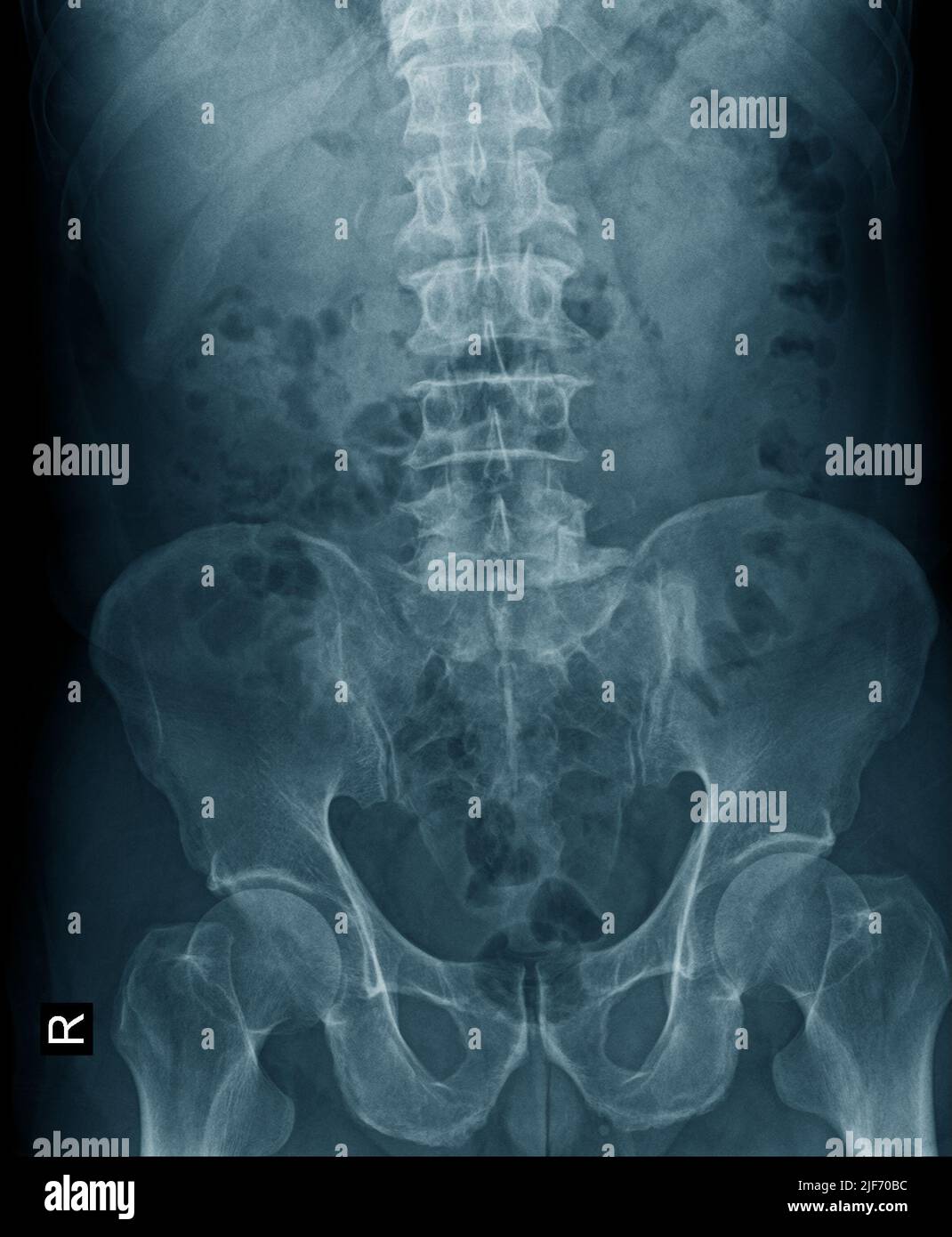 Sacral Foramina Xray
