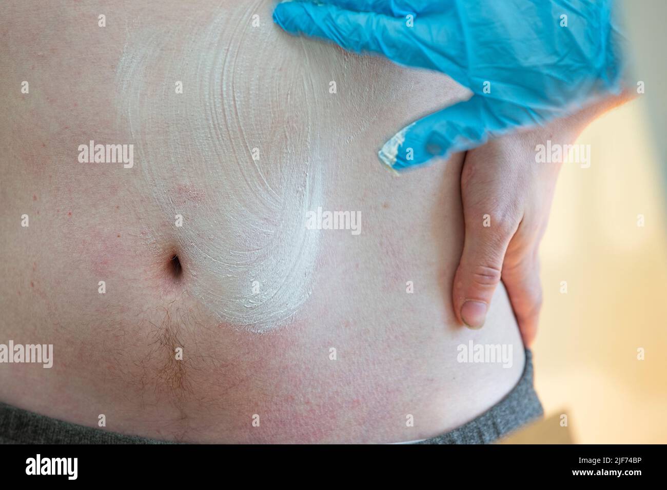 A nurse smears a body covered with an allergic rash to a patient.The ...