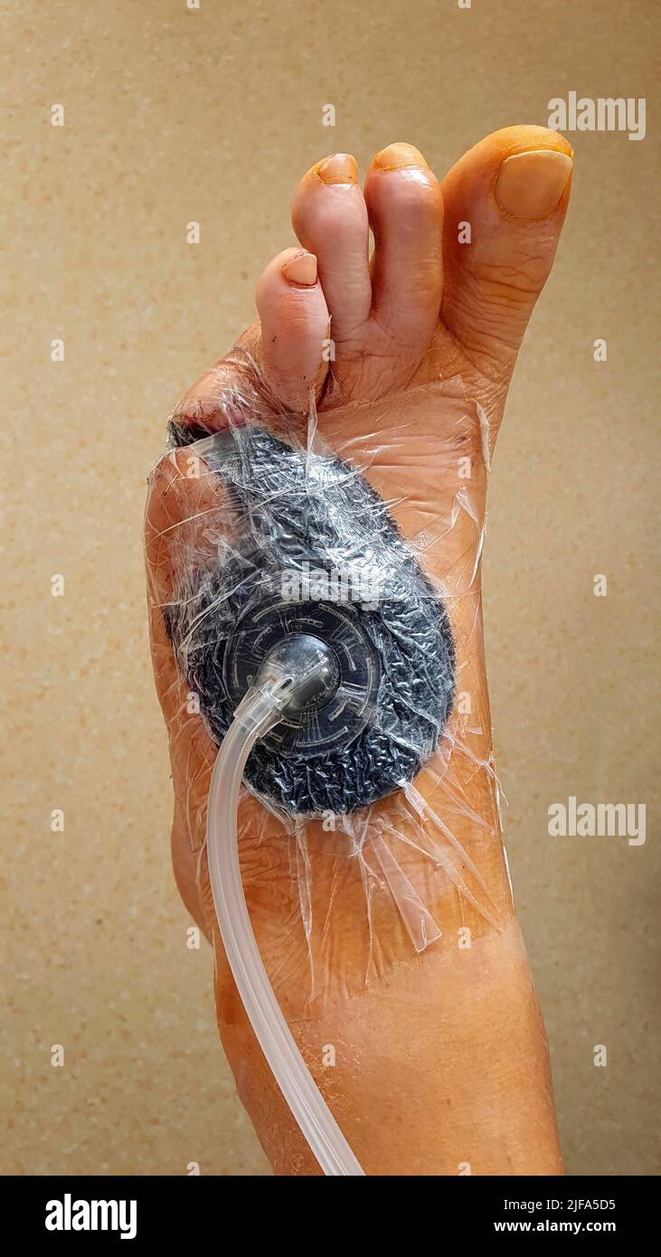 Vacuum therapy after surgery for diabetic foot syndrome, Hospital ...