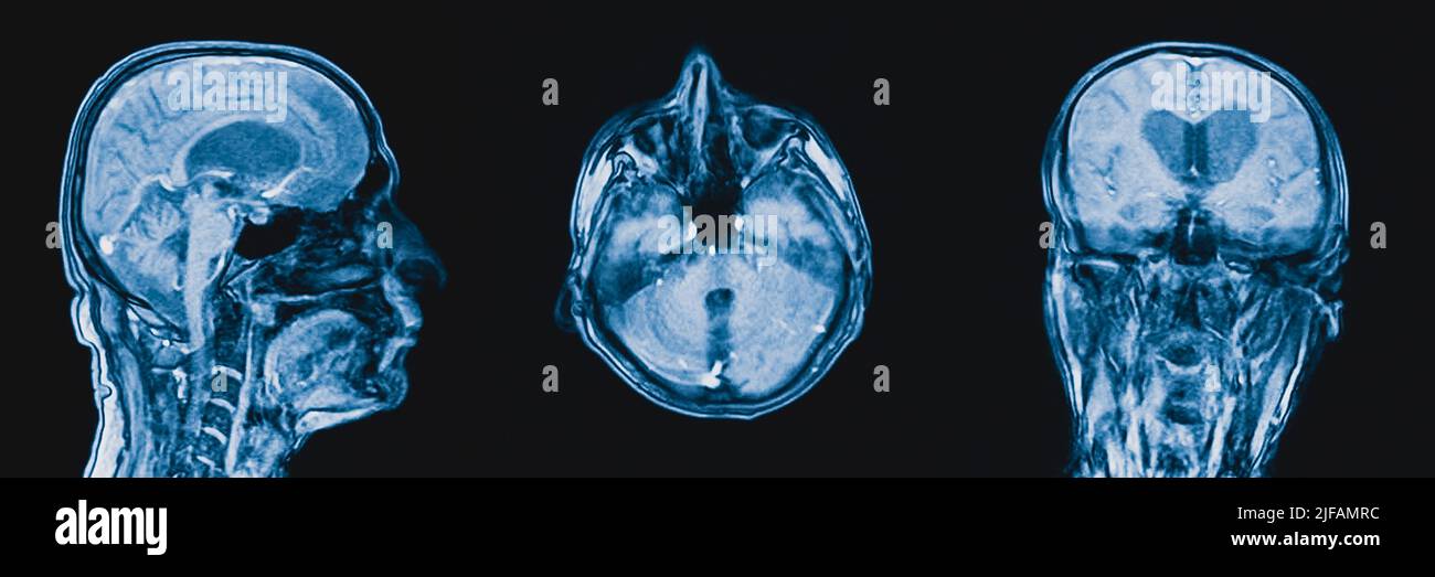 Human brain on MRI scans Frontal, sagittal and transverse sectional ...