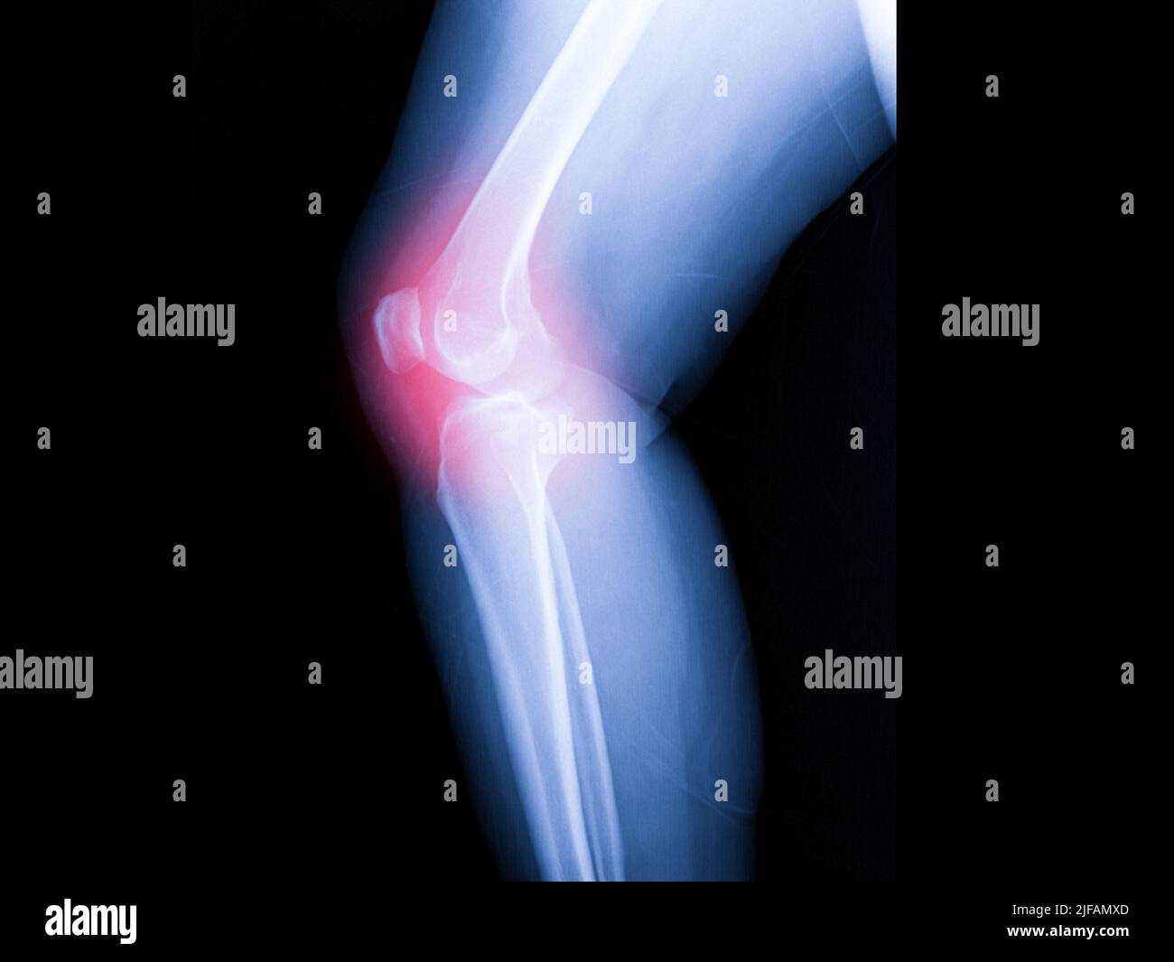 Knee joint ct scan hi-res stock photography and images - Alamy