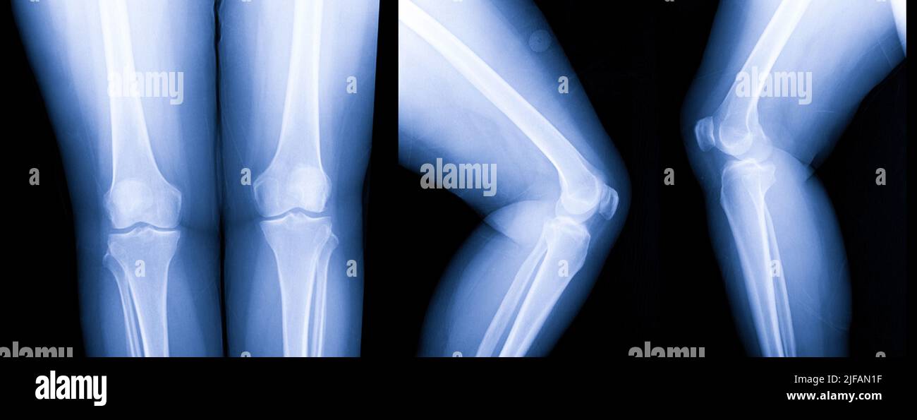 x-ray image of both knee, human's knee joints Stock Photo - Alamy