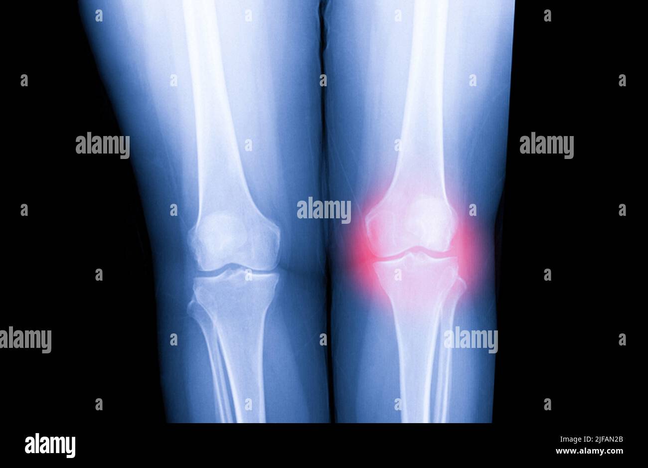Ct scan knee joint hi-res stock photography and images - Alamy