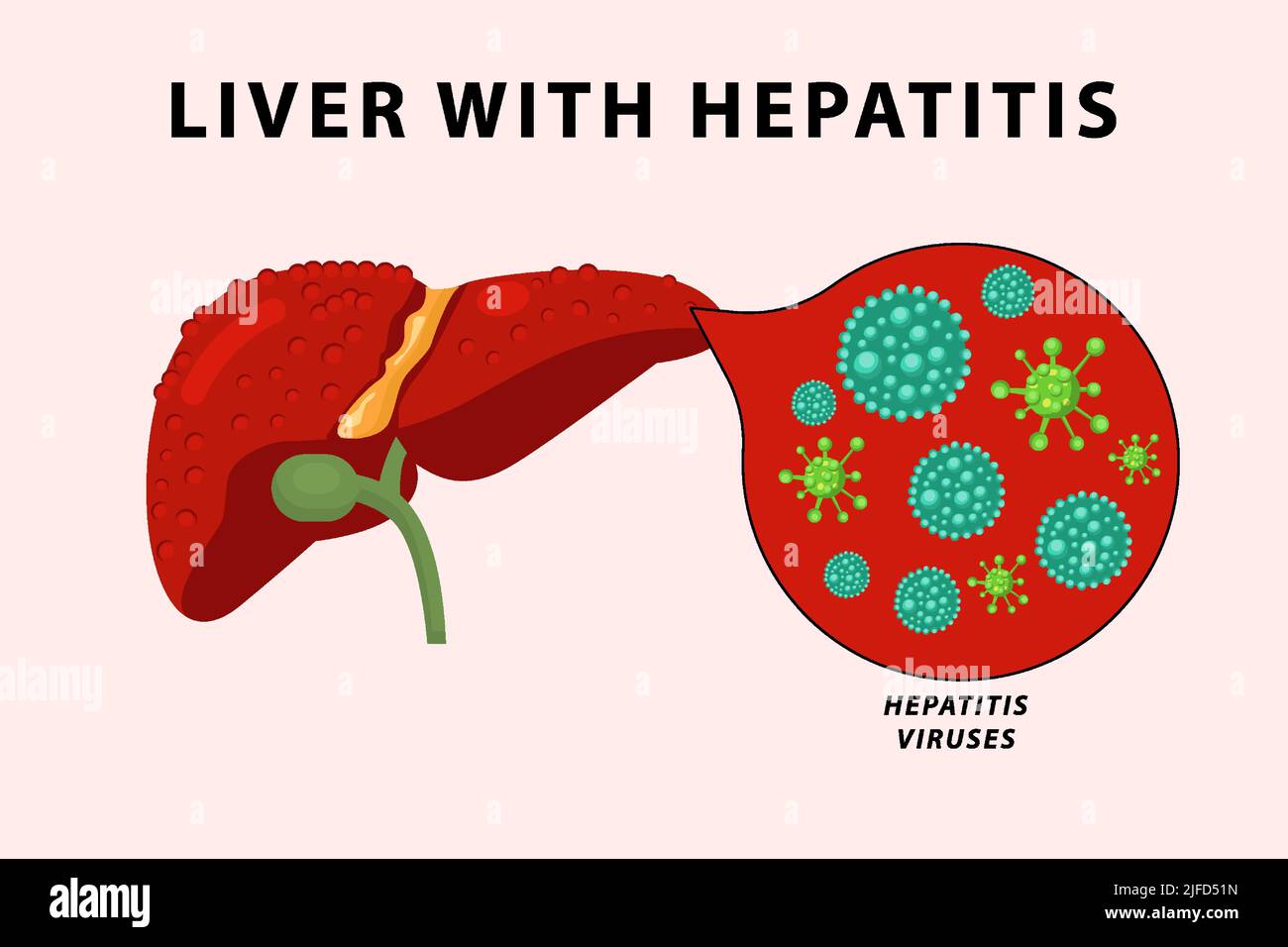 human liver hepatitis infection illustration Stock Vector Image & Art - Alamy
