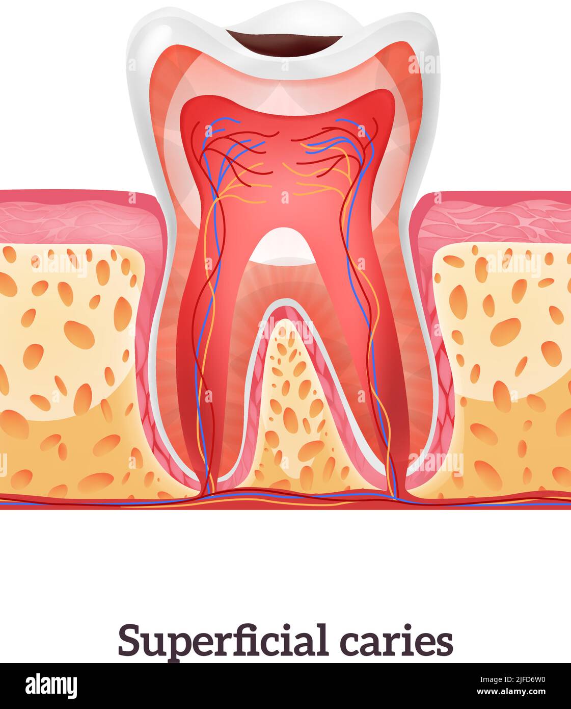 Tooth anatomy with superficial caries realistic vector illustration ...