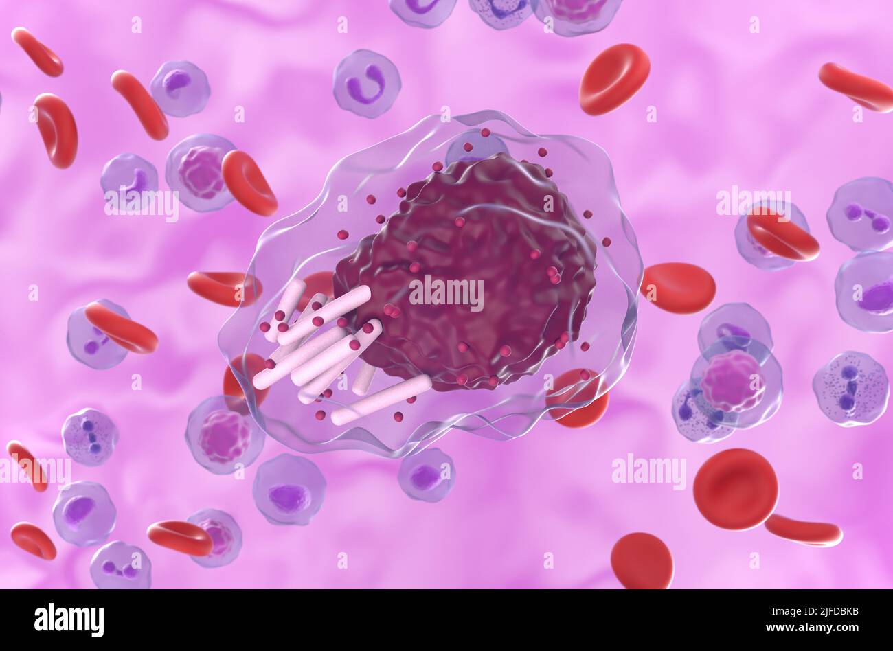 Chronic lymphocytic leukemia cll hi-res stock photography and images ...