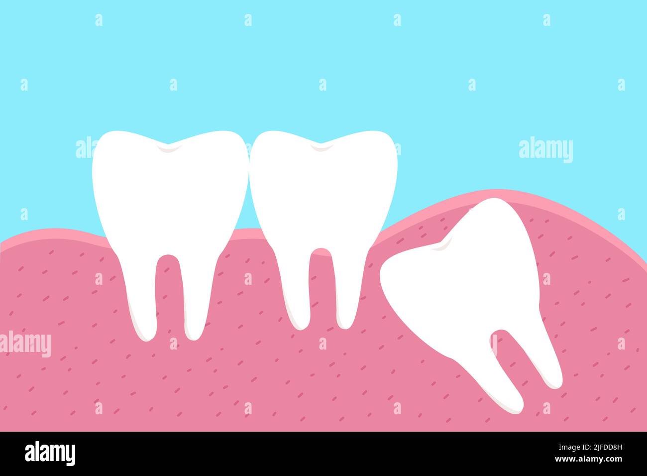Illustration of wisdom tooth.Dental concept Stock Photo - Alamy