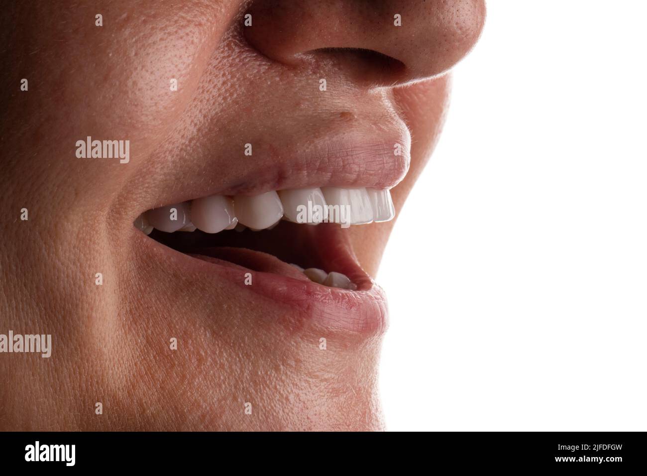 In this photo, you can see the smile design made by dentists with e-max ...