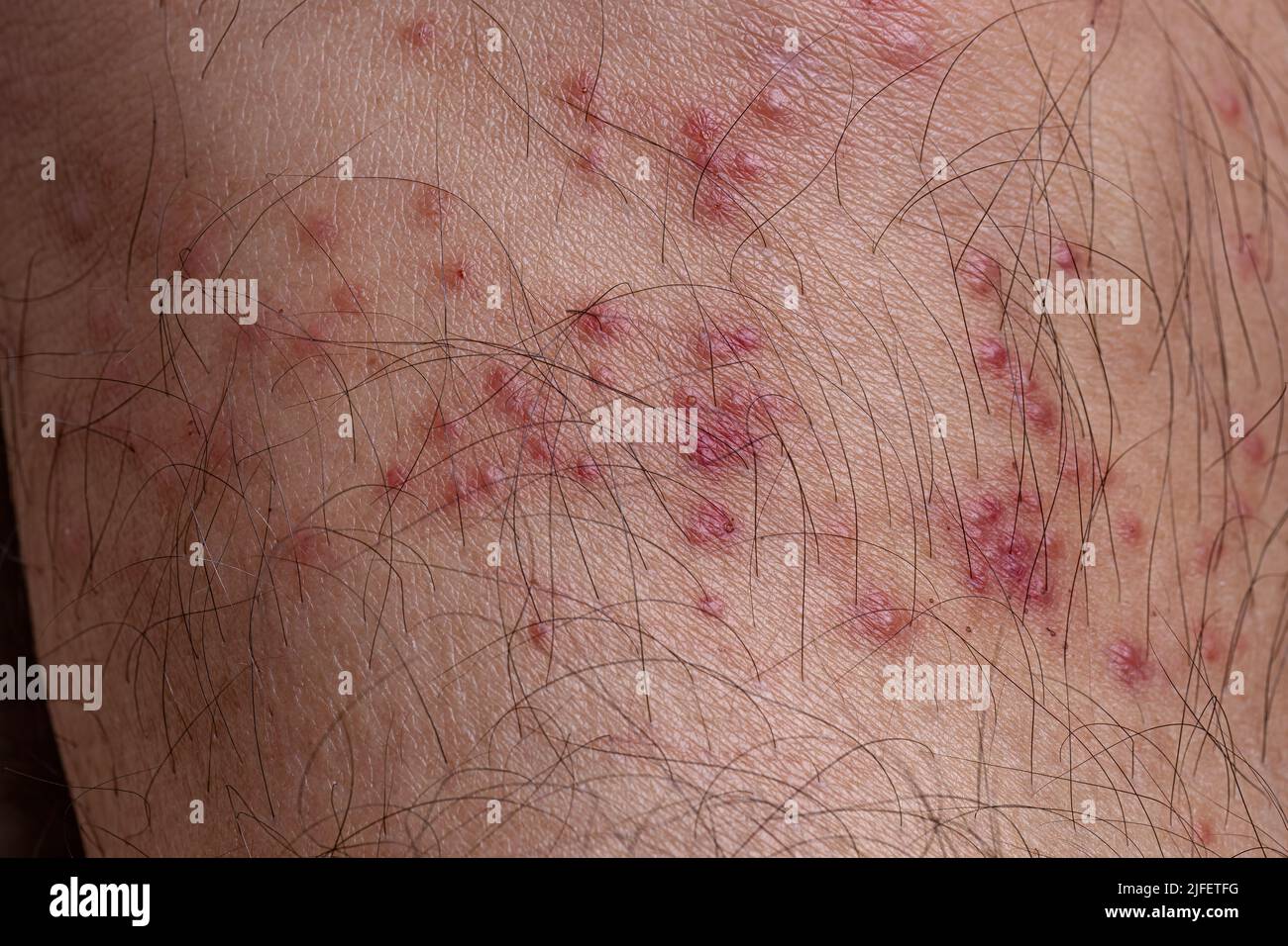 Human skin with various allergic reactions to tick bites with selective ...