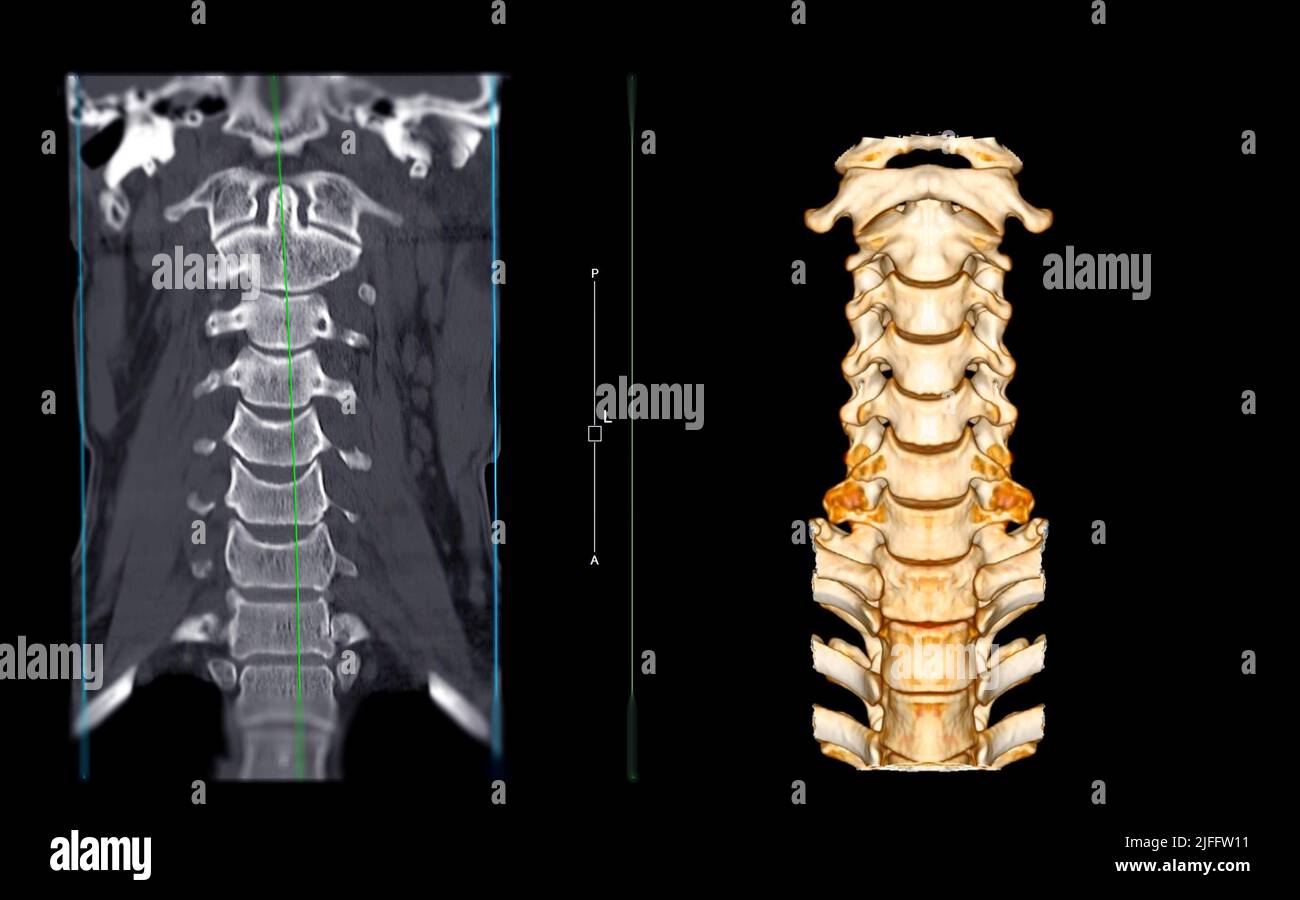 CT SCAN of Cervical Spine ( C-spine ) coronal view and 3D rendering ... CT SCAN of Cervical Spine ( C-spine ) coronal view and 3D rendering ...