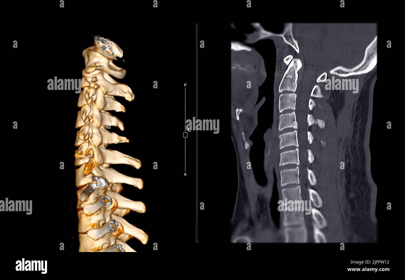 CT SCAN of Cervical Spine ( C-spine ) coronal and sagittal view in ...
