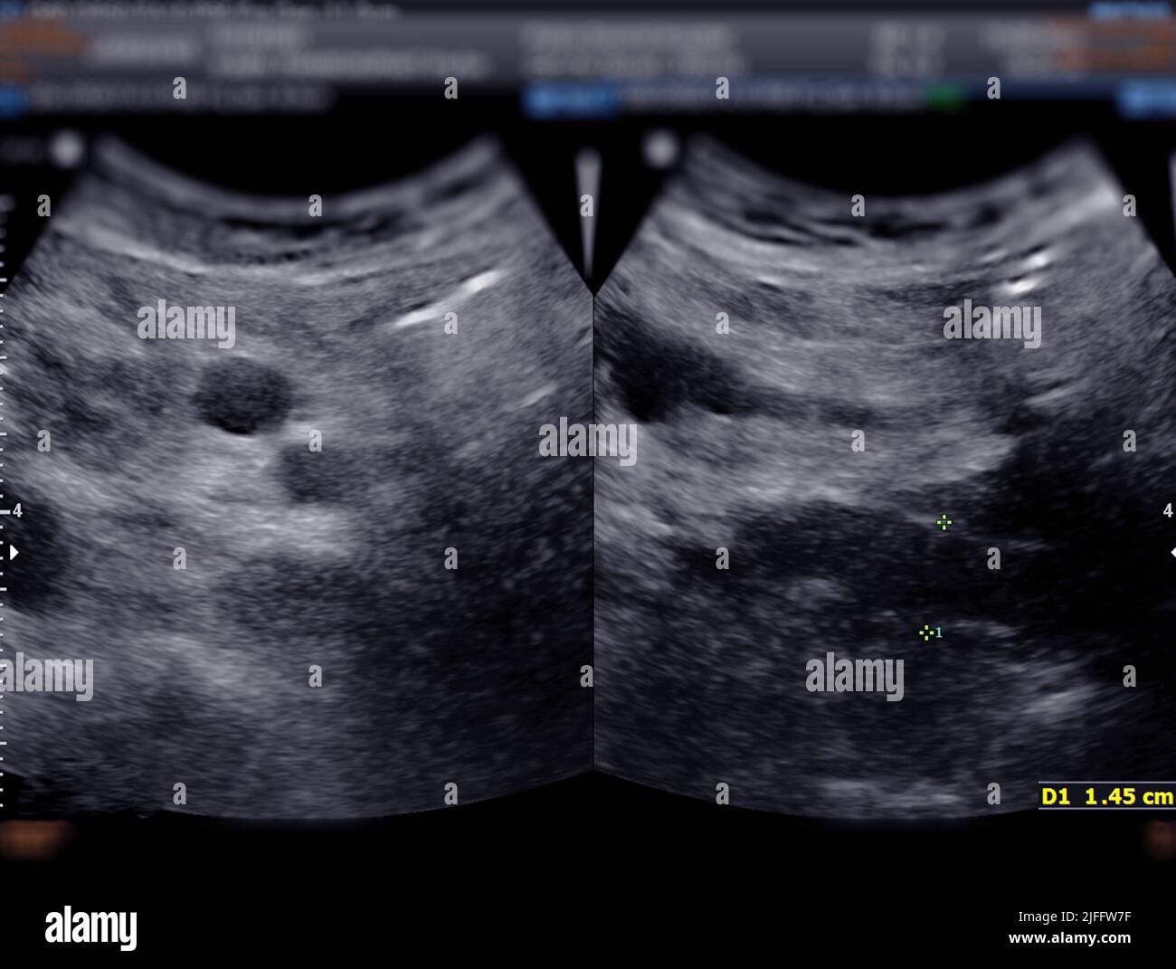 Ultrasound of urinary bladder or KUB for screening renal and bladder ...