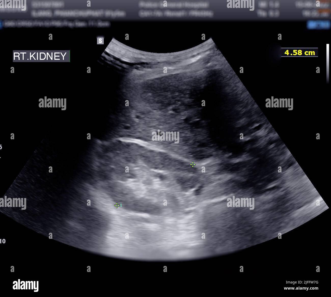 Ultrasound of urinary bladder or KUB for screening renal and bladder ...