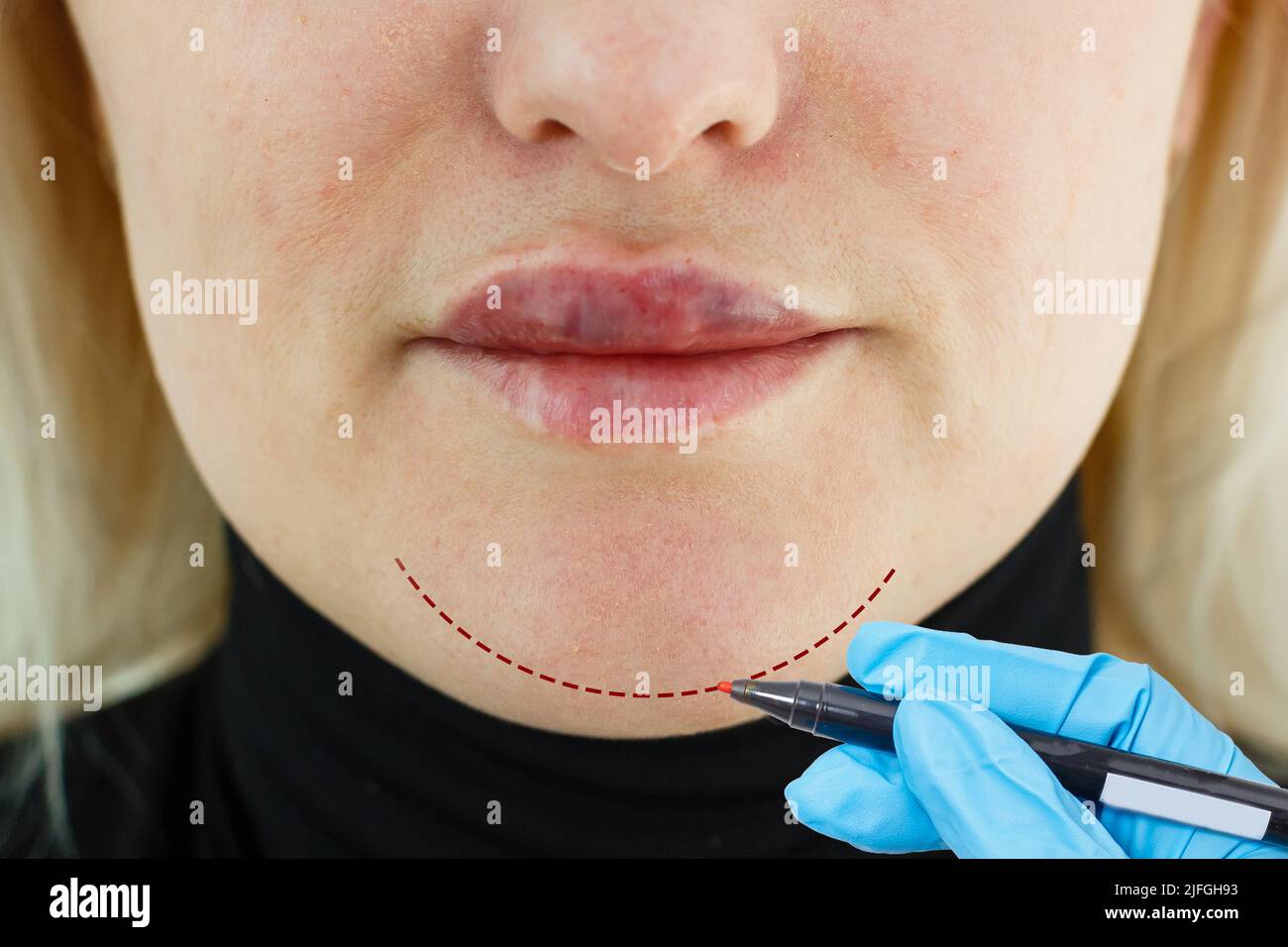 Plastic surgery doctor draw line on patient chin - cosmetic surgery ...