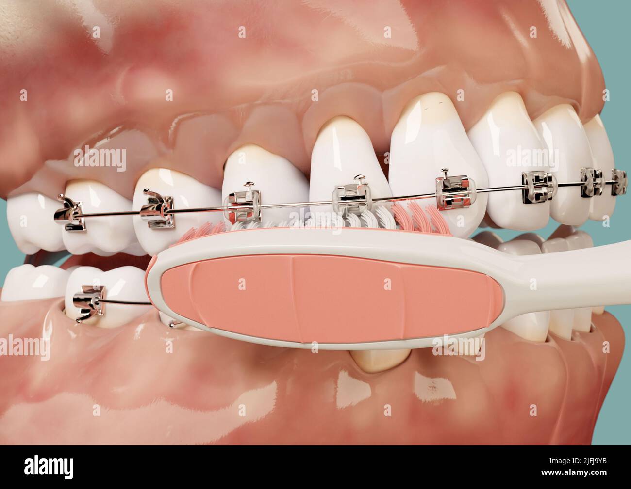The teeth with braces being brushed Stock Photo - Alamy