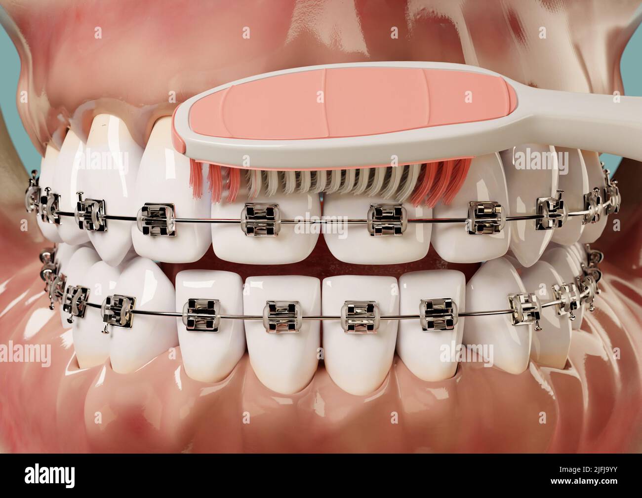 The teeth with braces being brushed Stock Photo - Alamy