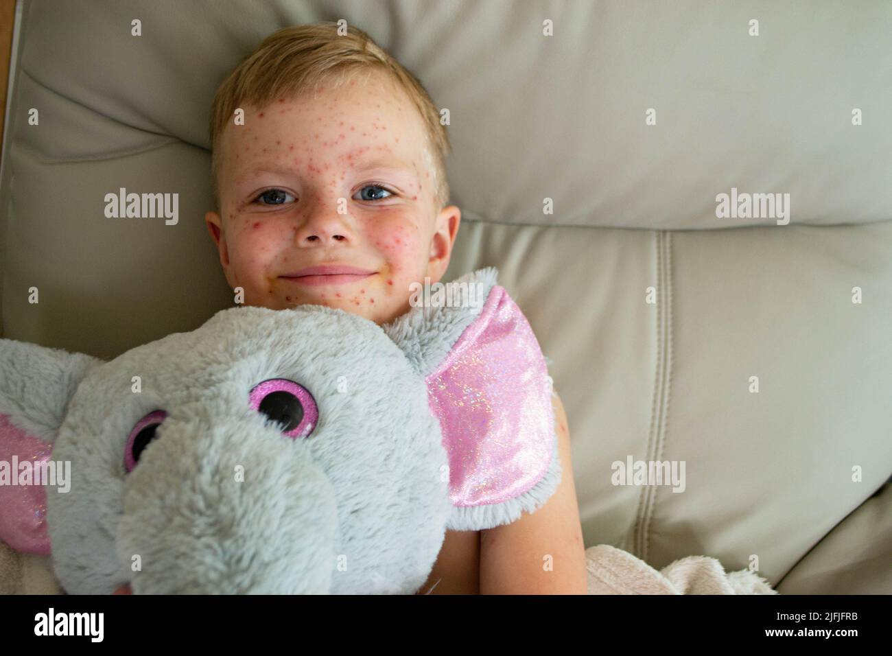 Smallpox vaccination boys hi-res stock photography and images - Alamy