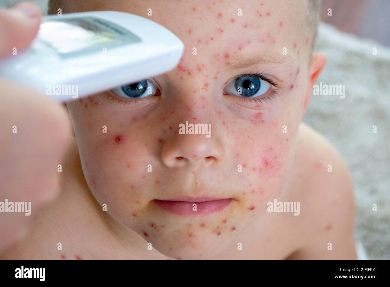 Smallpox vaccination boys hi-res stock photography and images - Alamy