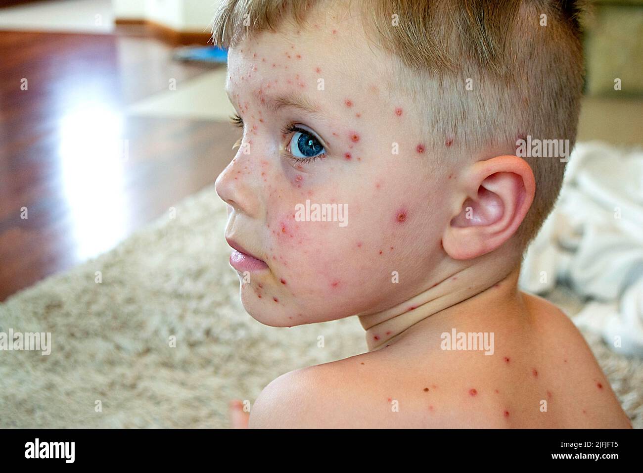 Smallpox vaccination boys hi-res stock photography and images - Alamy