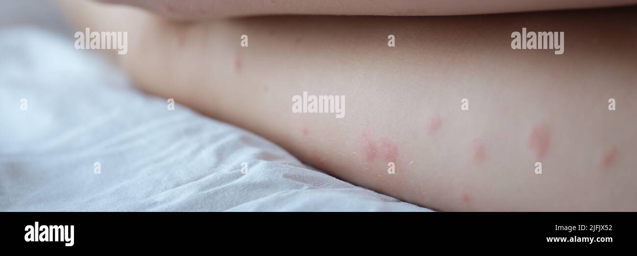 Red rash on the white skin of female legs, pimples Stock Photo - Alamy