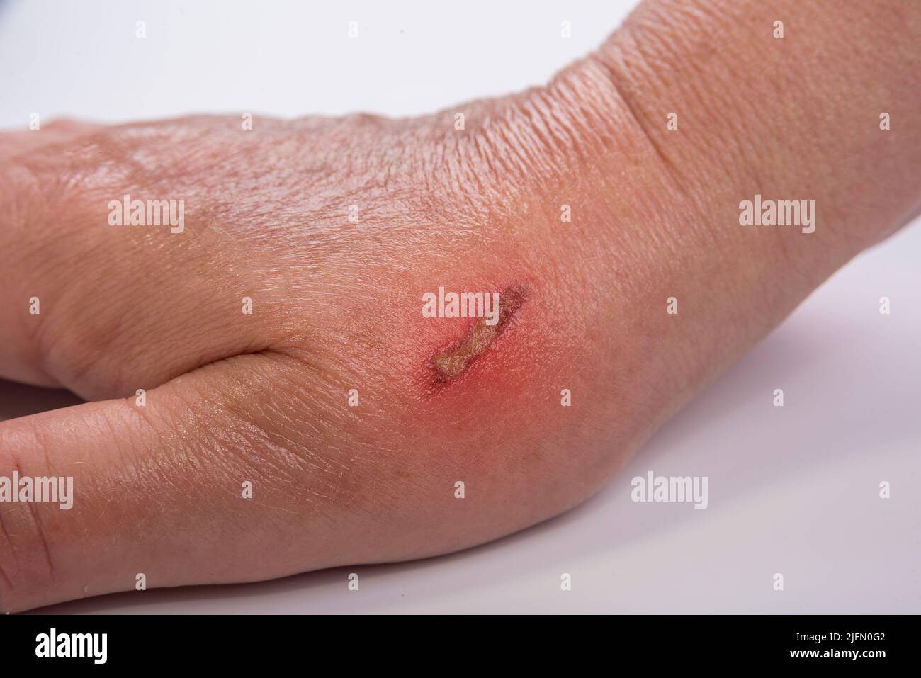 Burn scar hand hi-res stock photography and images - Alamy